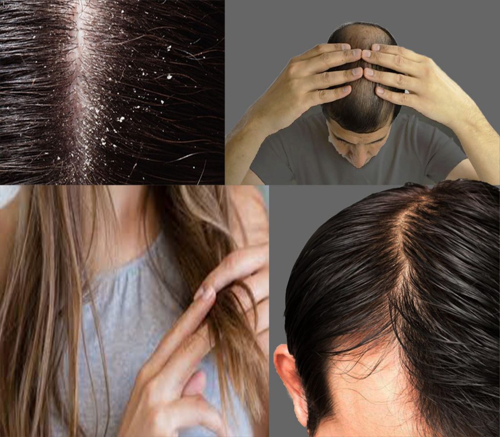 Types of hair problems: And How to get rid of hair problems? - Hair falled